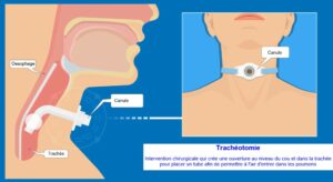 Trachéotomie et cancers de la tête et du cou (ORL)